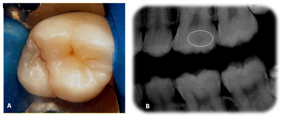 Tratamento de cárie sem dor: Pesquisadores da UFRN consolidam técnica ...