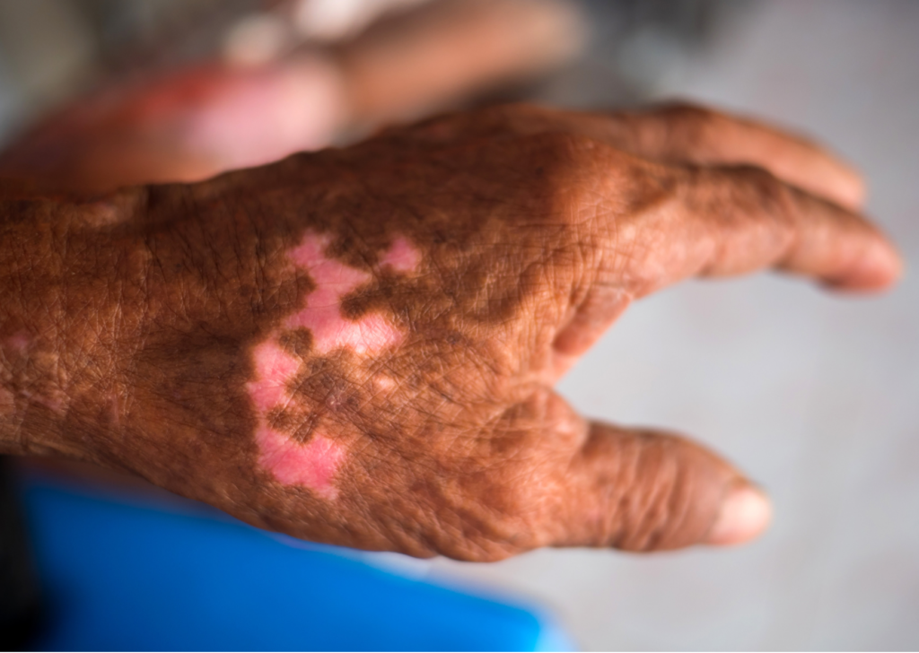 Janeiro é o mês de combate a hanseníase - Guia Viver Bem