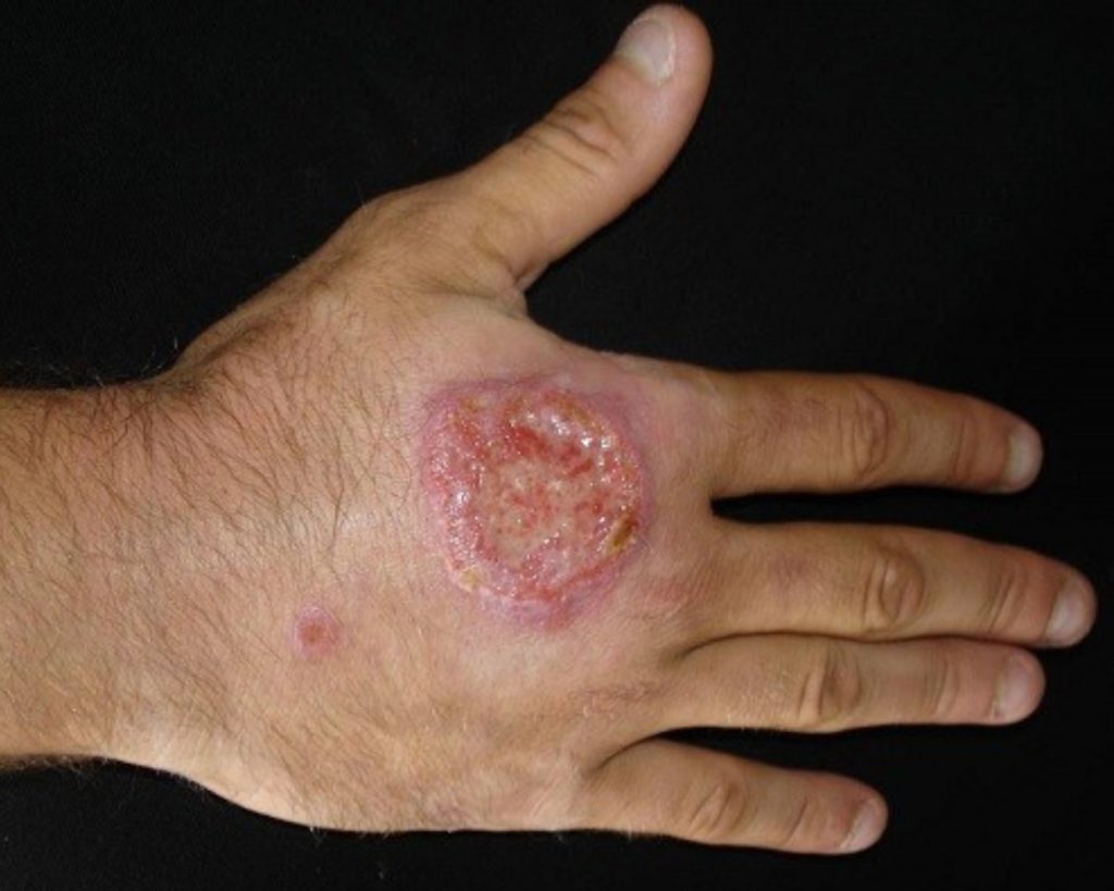 Mecanismo celular que torna leishmaniose mais grave é desvendado - Guia ...