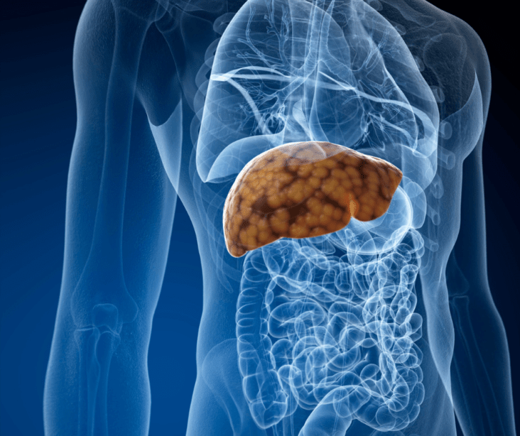 Os 7 sinais de gordura no fígado, doença que acomete 3 em cada dez ...