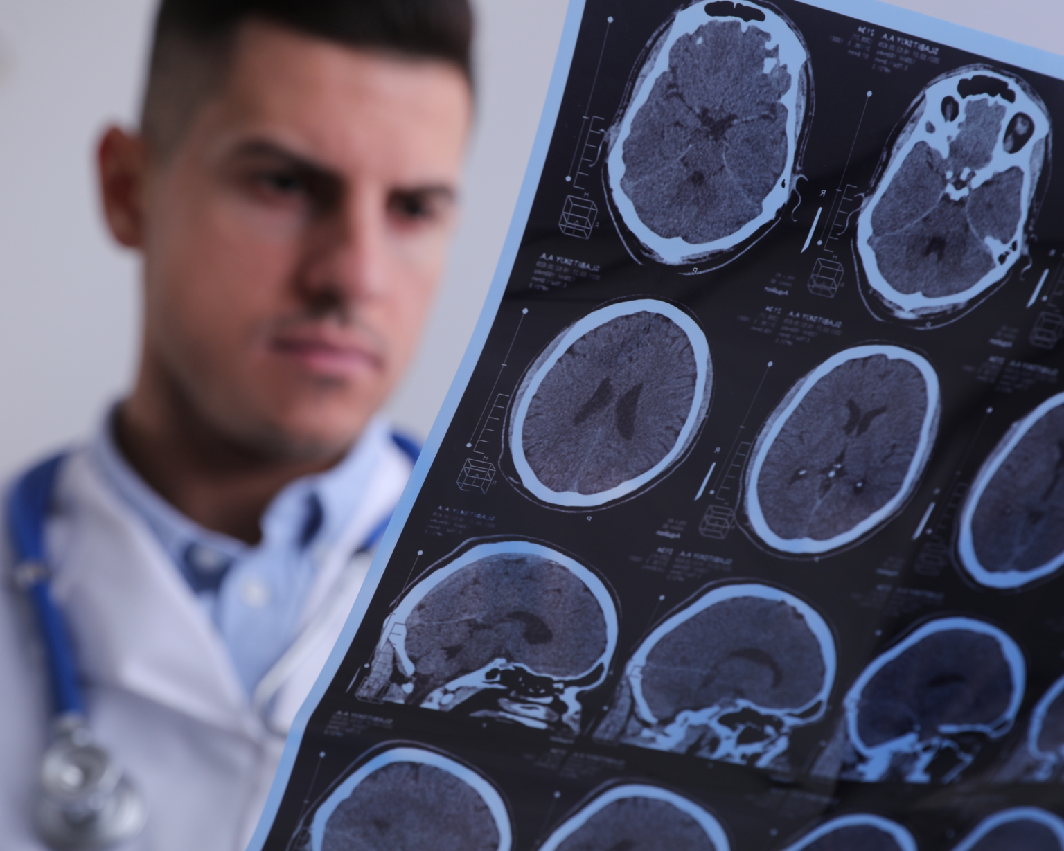 Segunda principal causa da morte no país, AVC também é sinal de alerta ...